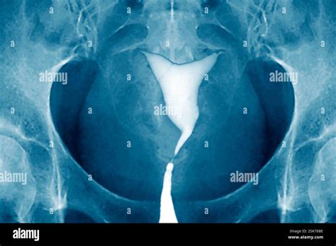 Blocked Fallopian Tubes Coloured Hysterosalpingogram X Ray The Pelvis Of A 25 Year Old Woman