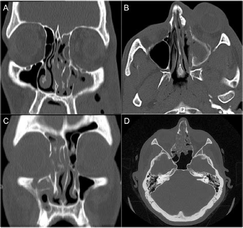 High Resolution Ct Images Acquired With Bone Algorithm And Windowed On