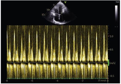 Unveiling Tuberculous Constrictive Pericarditis A Case Of Ascites As