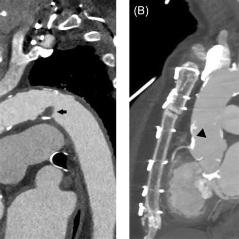 Sagittal Maximum Intensity Projection From Cta Chest Demonstrates