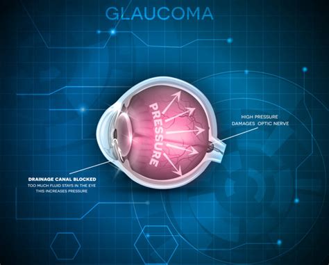 Glaucoma Correct Vision Laser Institute Glaucoma Weston Correct