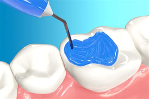 Different Types Of Adhesive Bonding Materials Industrial Material
