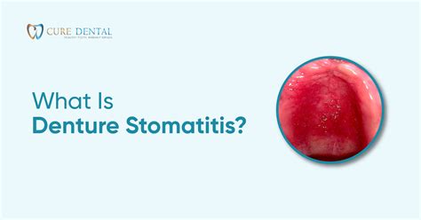 Denture Stomatitis Understanding Causes And Prevention