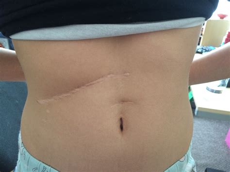 Liver Transplant Incision