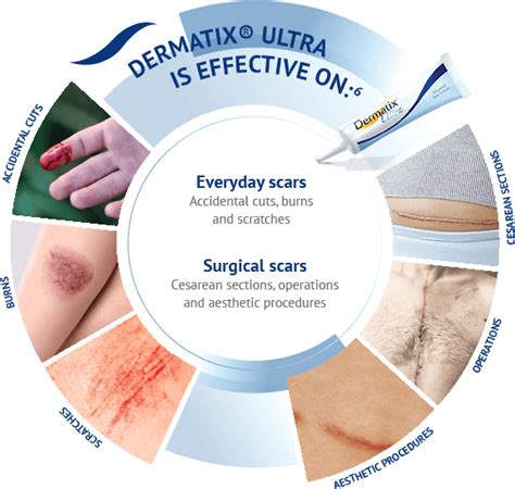 Dermatix® Ultra Dermatix® Asia