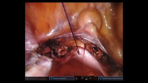 Bladder Flap Dissection Colpotomy And Vaginal Cuff Closure During