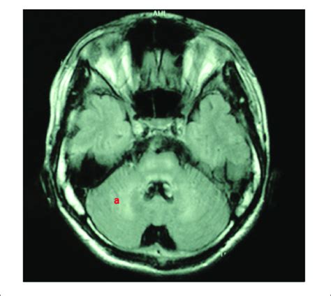 T2wi Flair Image In A 19 Year Old Male Axial Images Show