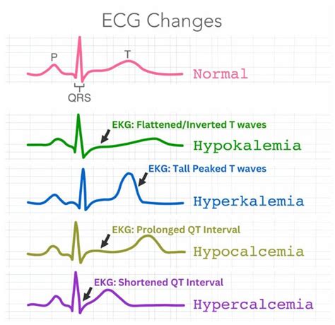 Electrolyte Imbalance Chart