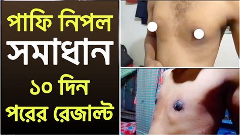 Grade 1 Puffy Nipple Gynecomastia Surgery Result Male Breast