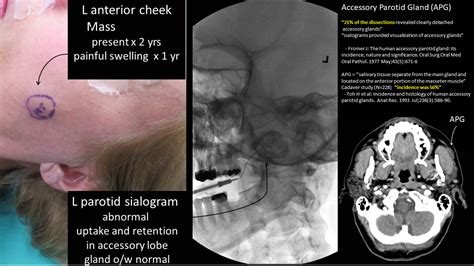 Parotid Gland Accessory Lobe And Facial Process Management