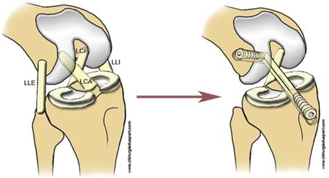 Las Técnicas Actuales Reconstrucción Del Lca Tendón De La Corva Kj Dt4 Tls Fascia Lata
