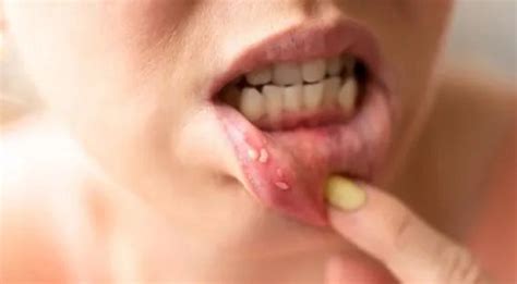 Multiple Canker Sores At Once Heres How You Can Get Rid Of It In 24h