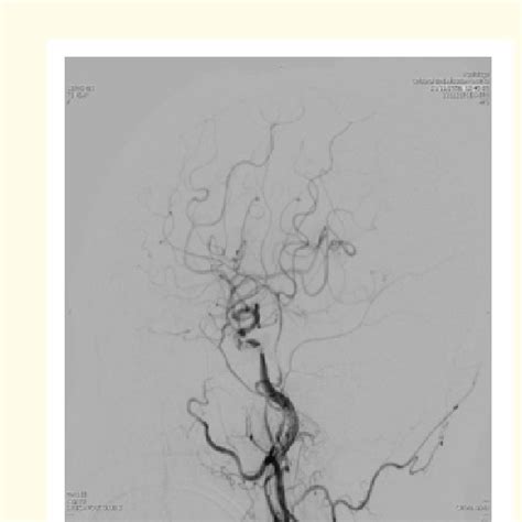 Post Embolization Control Angiogram Shows Complete Obliteration Of Download Scientific Diagram