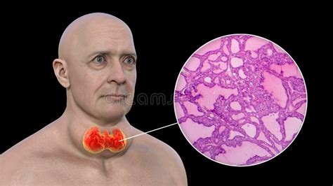 A Man With Enlarged Thyroid Gland 3d Illustration And Micrograph
