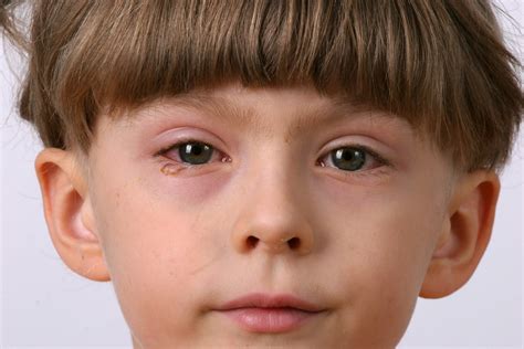 Conjunctivitis Treatment Protocols Lack Uniformity Across The Us
