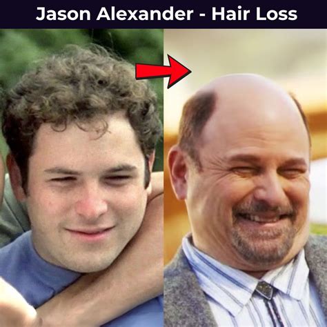 Jason Alexander Hair Transplant Before And After