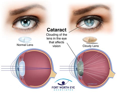 Cataract Lens Fw Eyes