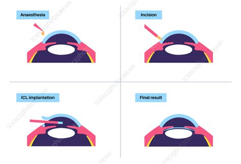 Implantable Collamer Lens Surgery Illustration Stock Image F043