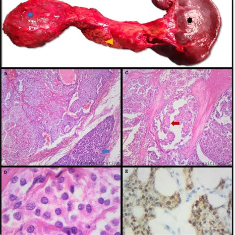 Macroscopic And Microscopic Photographs Of Solid Pseudopapillary Tumour