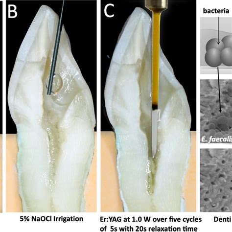 Schematics Of The Tooth Root Canal Treatment And Removal Of Bacteria