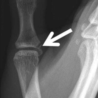 Multimodality Approach To A Stener Lesion Radiographic Ultrasound