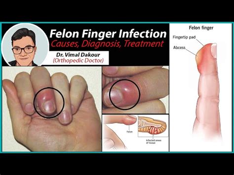 What Causes A Felon Finger