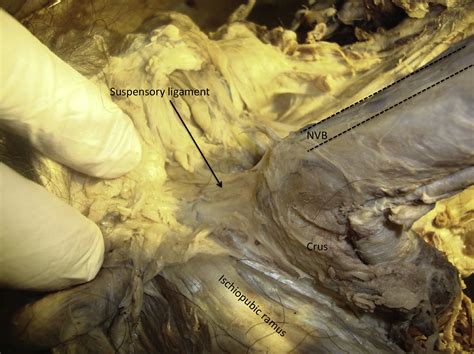 Kelly Procedure For Exstrophy Or Epispadias Patients Anatomical