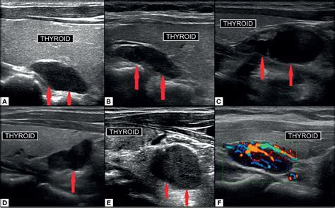 Parathyroid Gland Ultrasound Frontiers Preoperative Ultrasound