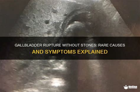 Gallbladder Rupture Without Stones Rare Causes And Symptoms Explained Medshun