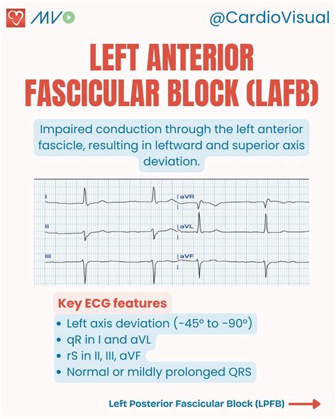 Cardiovisual Heres A Look Into Bundle Branch Blocks Facebook