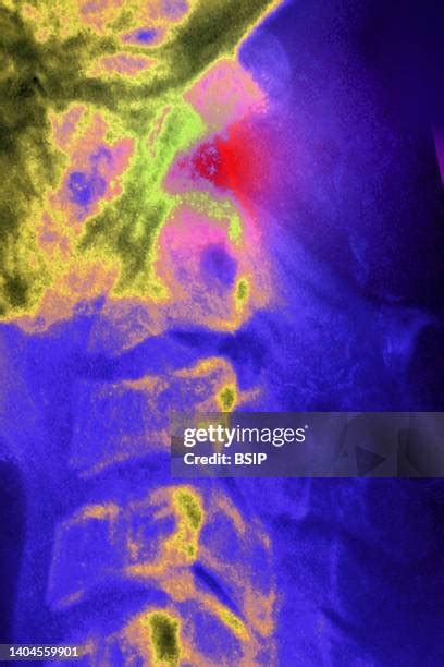 Cervical Spines Photos And Premium High Res Pictures Getty Images