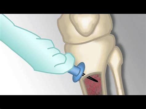 Intraosseous Infusion Sites