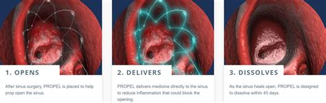 Propel® Sinus Stent Tampa Fl Nasal And Sinus Services