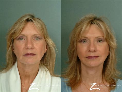 Facelift Before And After Gallery