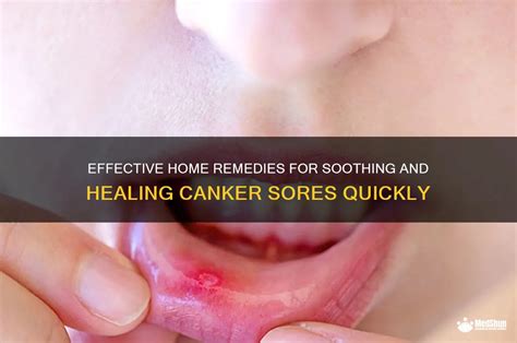 Effective Home Remedies For Soothing And Healing Canker Sores Quickly