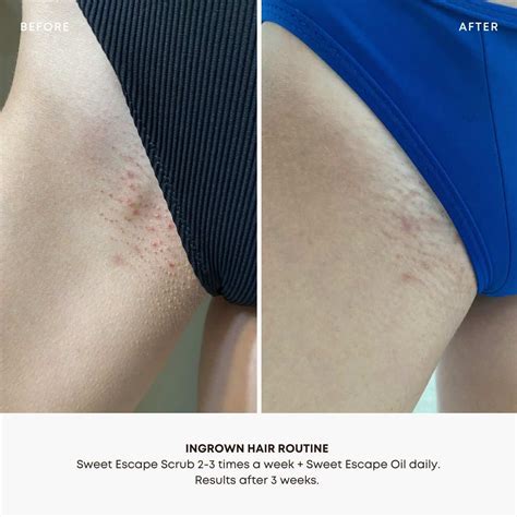 Bushbalm Sweet Escape Scented Ingrown Hair And Bikini Bump Treatment