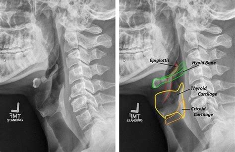 Epiglottitis X Ray Cindytemckenzie