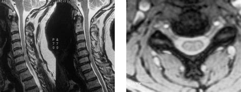 A T 2 Weighted Sagittal Image Demonstrates The Myelographic Effect Of