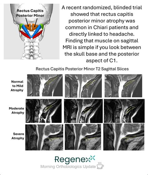 Rectus Capitis Posterior Minor Atrophy Is Probably Worth Looking For In Chiari 0 And 1 Patients