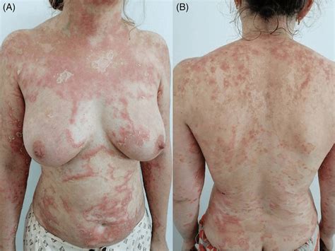 Generalized Annular Lesions With An Erythematous Pustular Margin Download Scientific Diagram