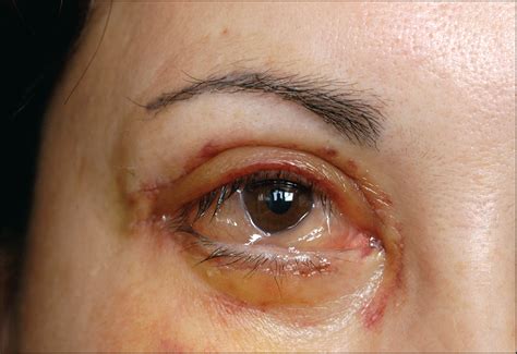 Eyes Are Swollen Chemo At Jose Huggins Blog