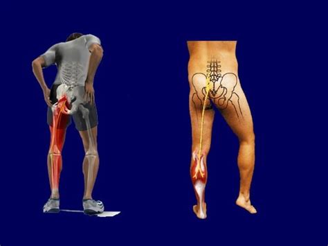 Hamstrings Sciatic Nerve Ppt