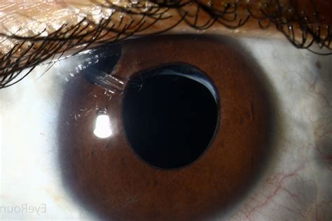 28 Facts About Aphakia