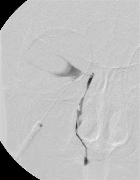 Diagram Of Dacrocystogram Digital Subtraction Quizlet