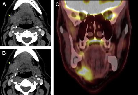 Imaging Of Submandibular And Sublingual Salivary Glands Neuroimaging