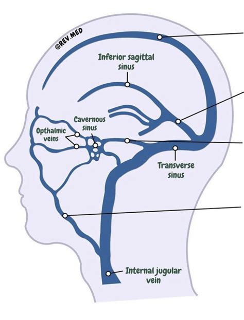 Venous Sinus Stenosis Vss And Its Role In Iih Iih Hub