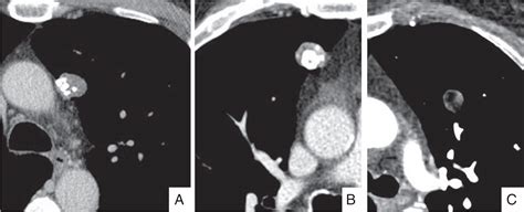Incidental Pulmonary Nodules Characterization And Management