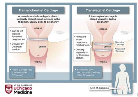 Uchicago Medicine Transabdominal Cerclage Team Helps Prevent Pregnancy