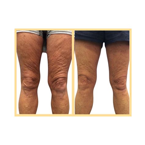 Sentient® Sculpt™ Body Contouring — You Medical Aesthetics Med Spa
