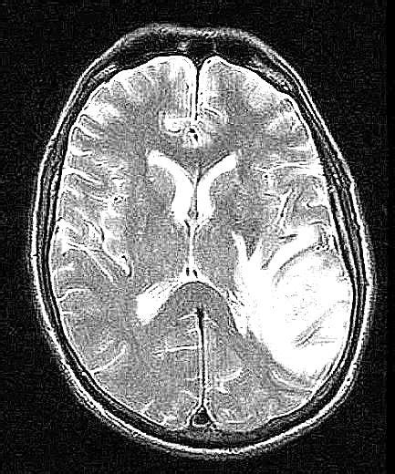 Tumordetection Object Detection Model By Fast